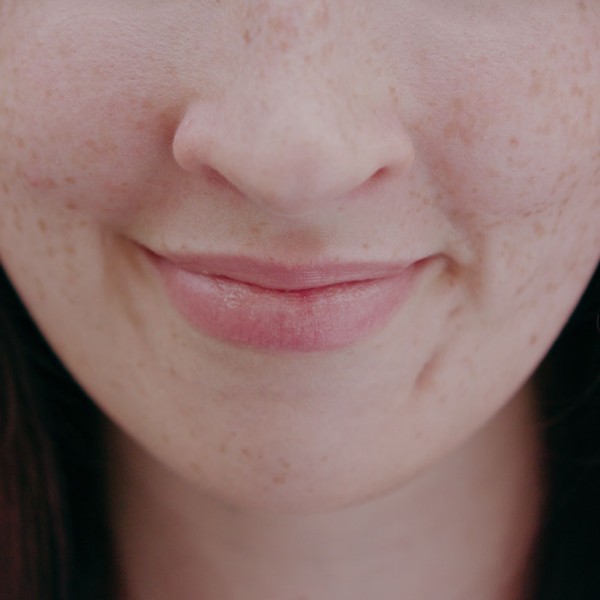 Education for Scar, Stretch Marks & Cold Sores | Mederma®